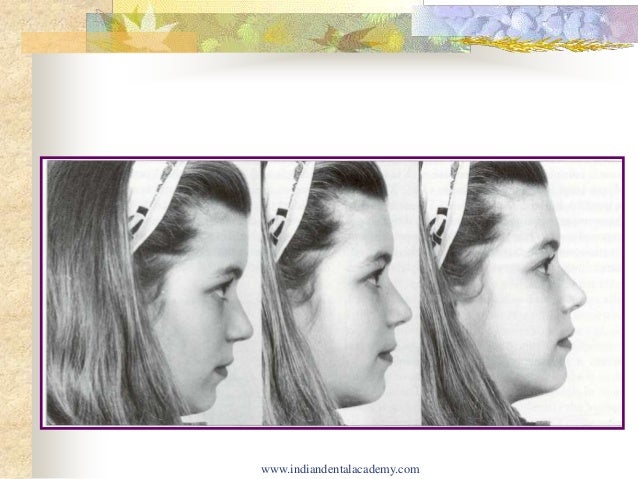 Natural head position