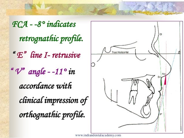 Natural head position