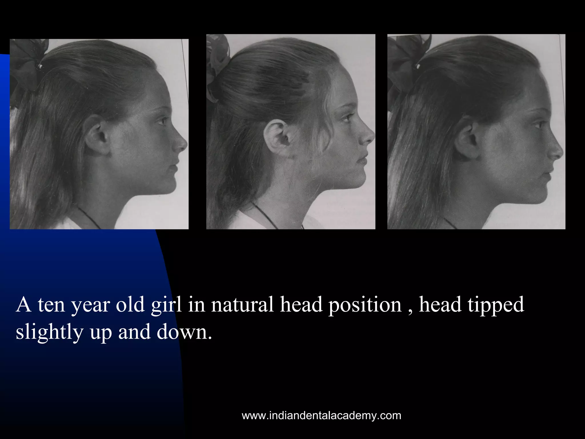 Natural head posture /certified fixed orthodontic courses by Indian ...