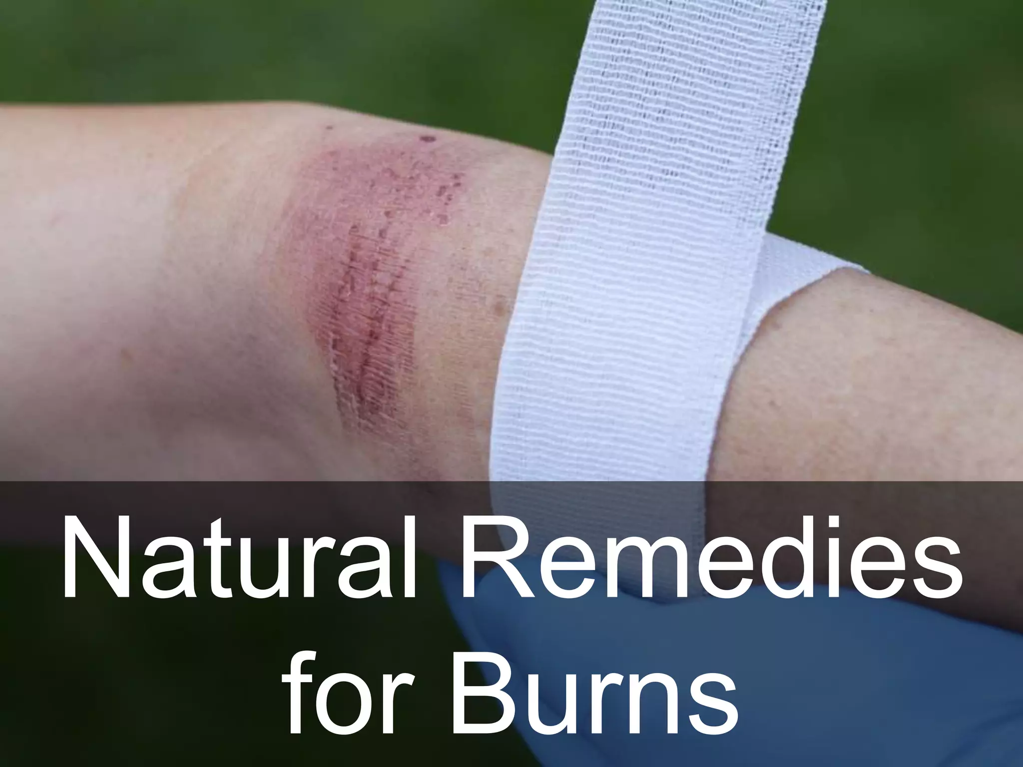 Natural remedies for burns | PPTX | Herbs and Supplements | Alternative ...