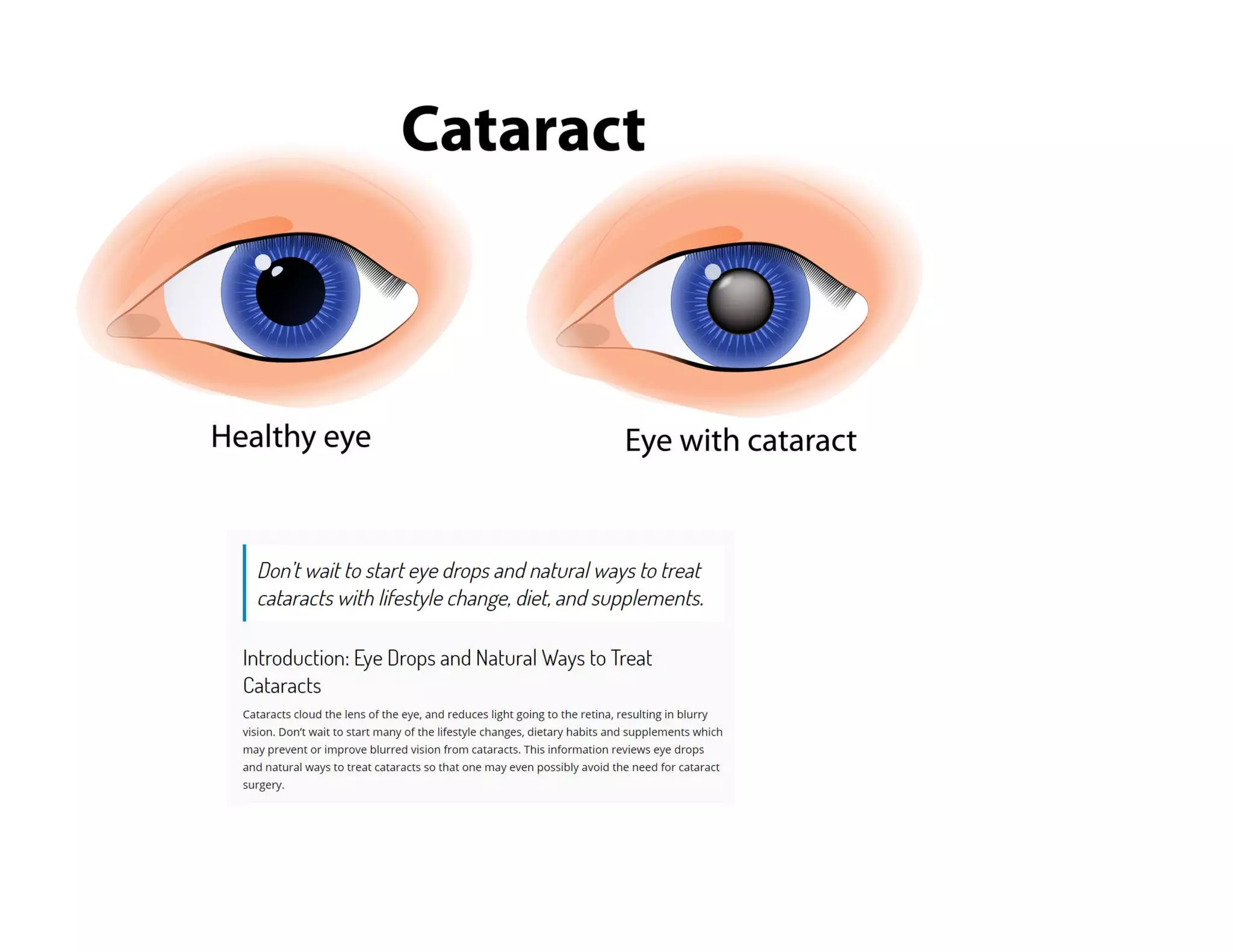 Natural ways to treat cataracts1 | PPTX