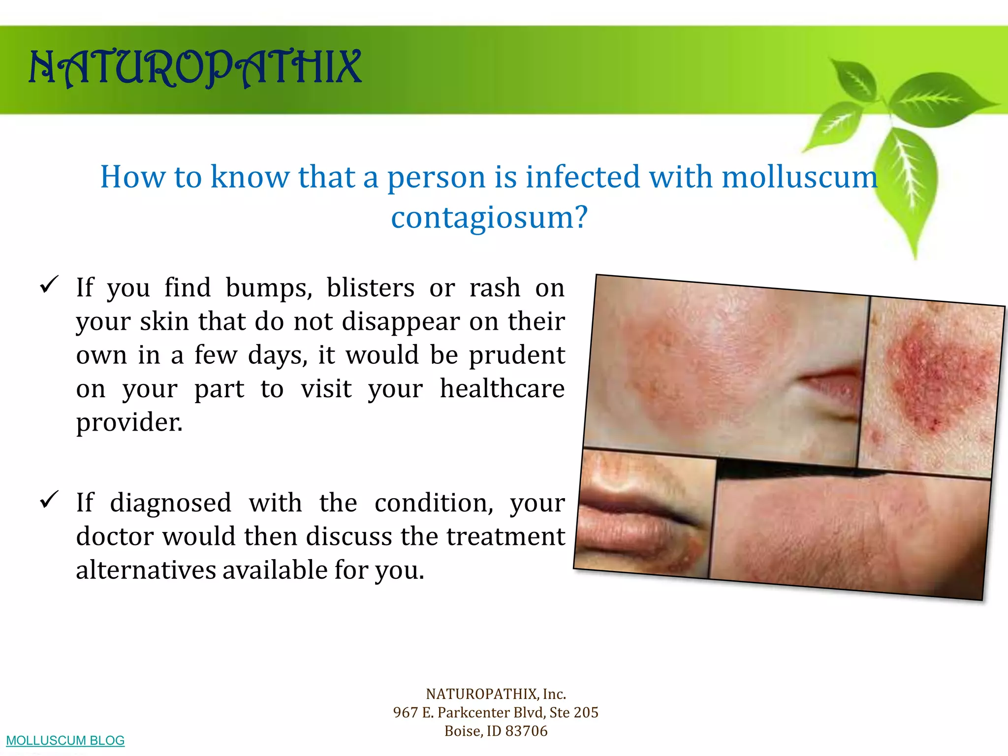 Molluscum Contagiosum Treatment | PPTX | Infectious Diseases | Diseases and Conditions