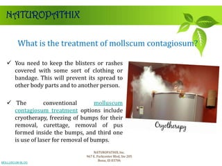 Molluscum Contagiosum Treatment | PPTX | Infectious Diseases | Diseases and Conditions