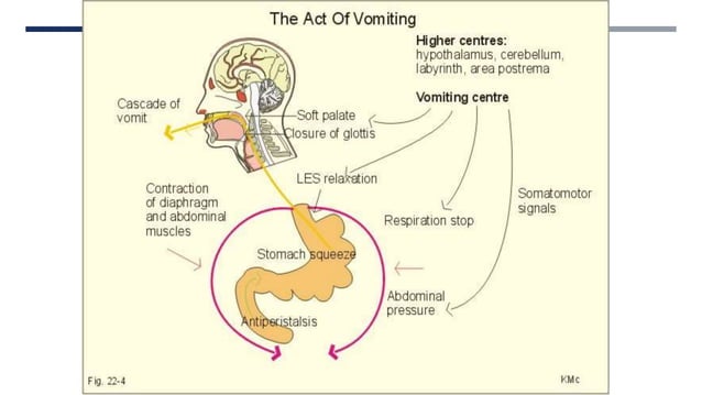 Physiology of Nausea and vomiting , PONV, guidelines and management | PPTX