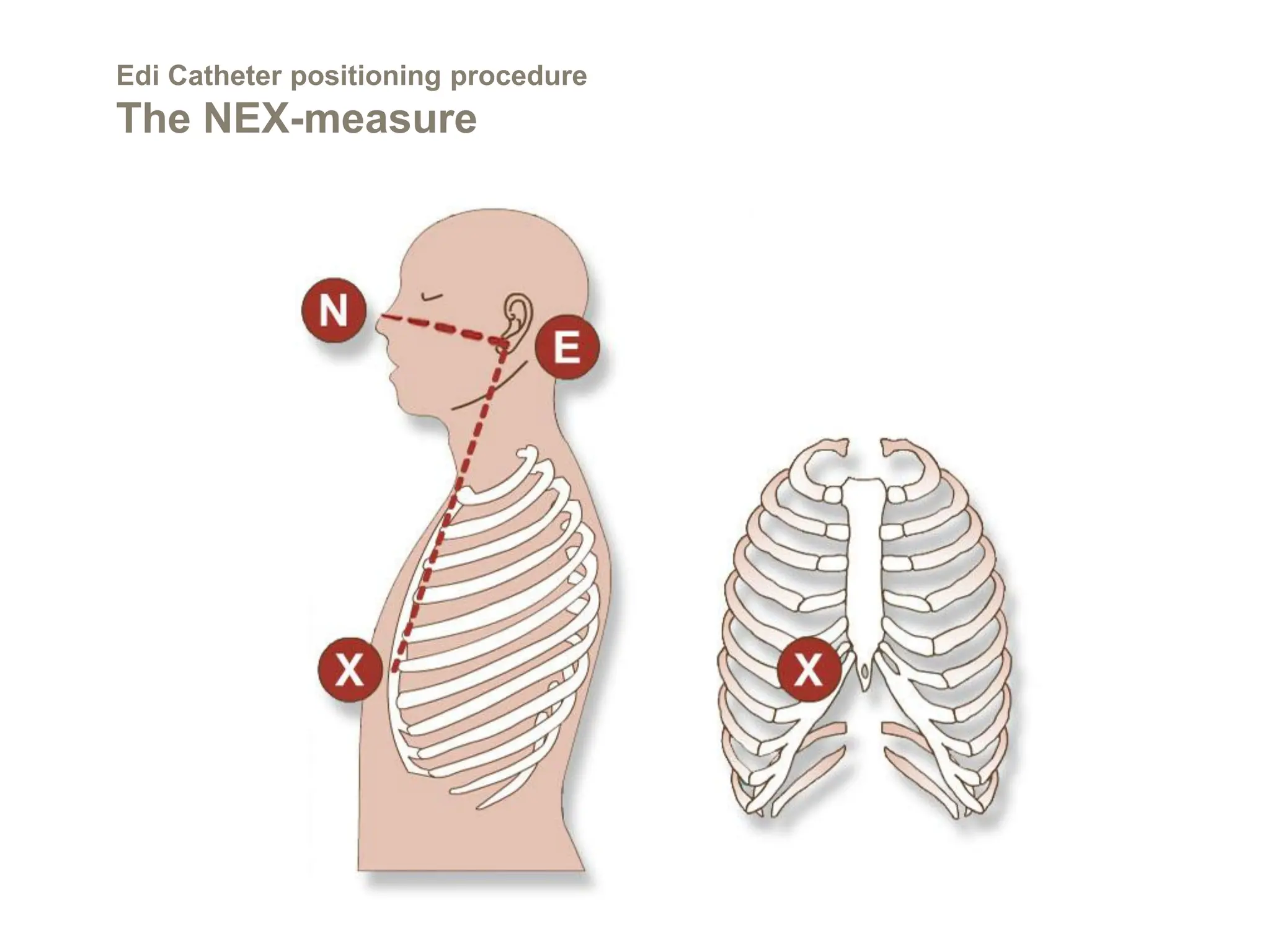 Getinge ventilation strategy using nava ventilation | PDF