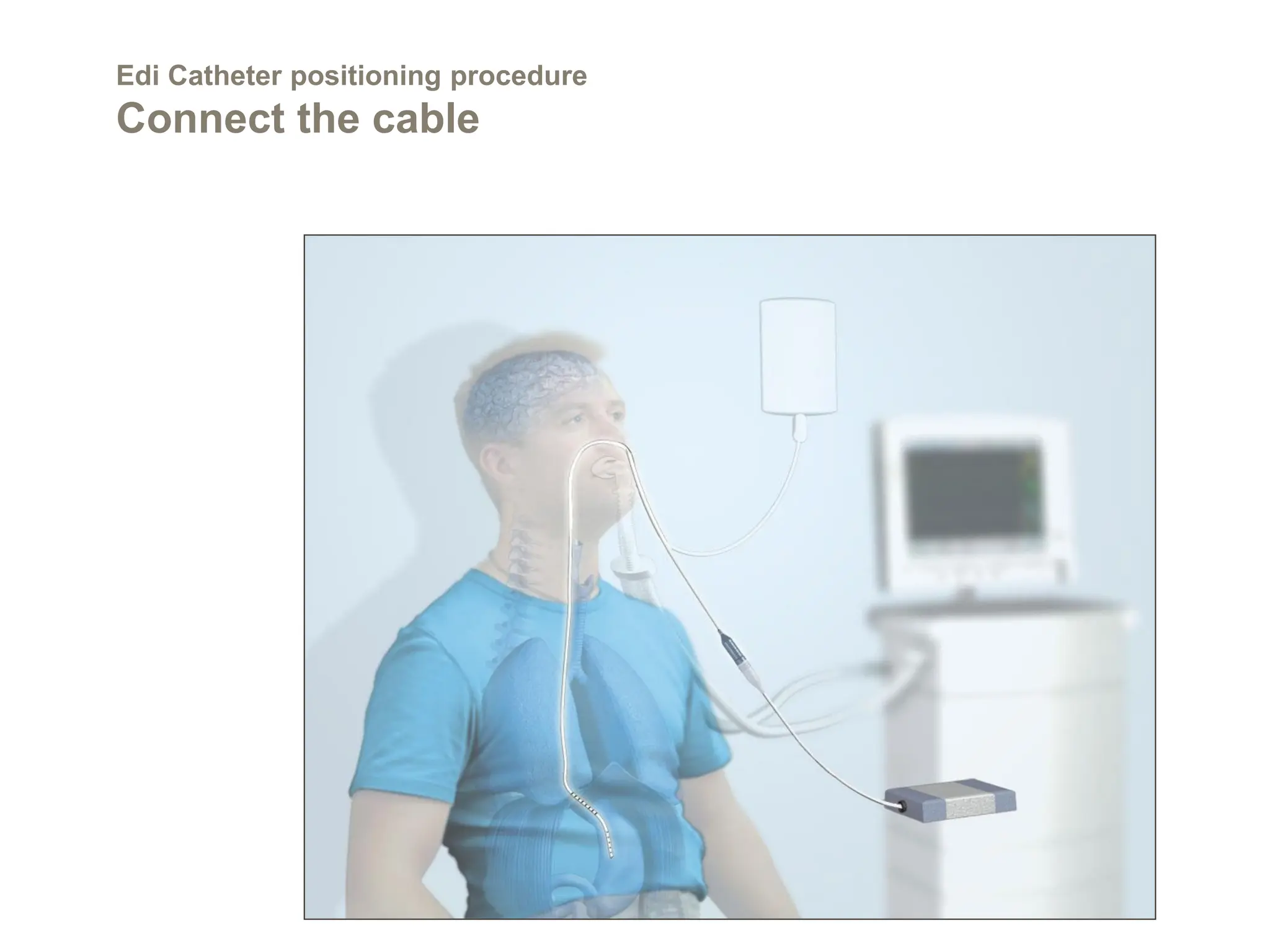 Getinge ventilation strategy using nava ventilation | PDF