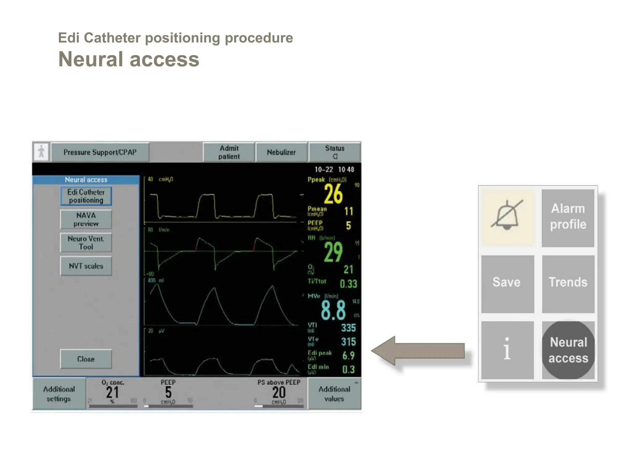 Getinge ventilation strategy using nava ventilation | PDF