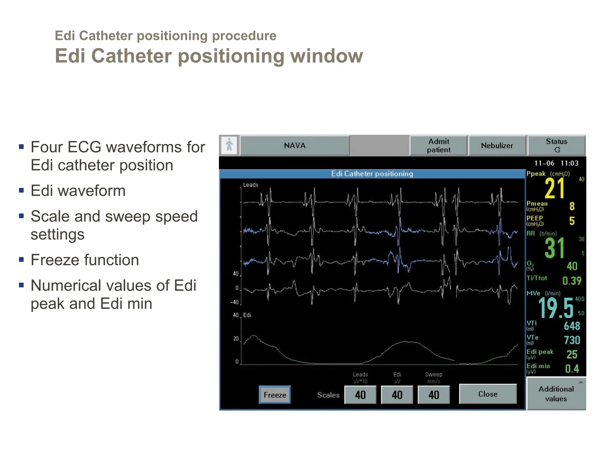Getinge ventilation strategy using nava ventilation | PDF