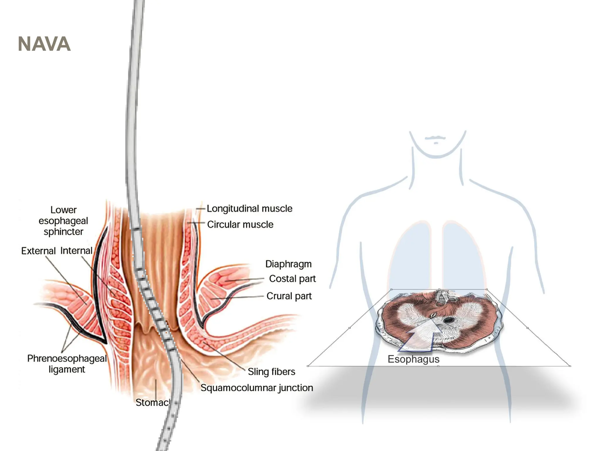 Getinge ventilation strategy using nava ventilation | PDF