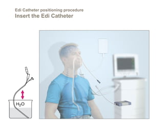 Getinge ventilation strategy using nava ventilation | PDF