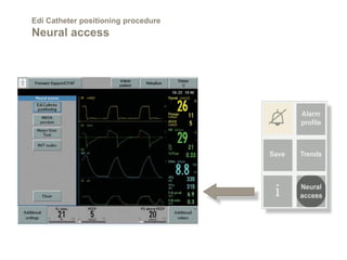 Getinge ventilation strategy using nava ventilation | PDF