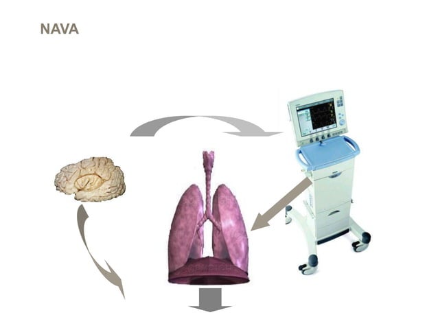 Getinge ventilation strategy using nava ventilation | PDF | Lung and ...