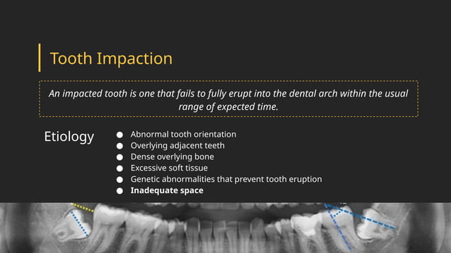 Navigating Wisdom Tooth Impaction.pptx dan | PPT