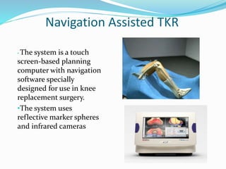 Navigation Assisted Total Knee Replacement | PPTX