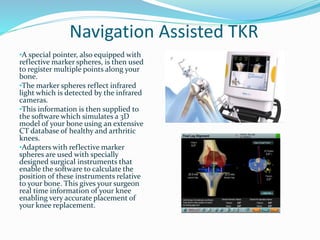 Navigation Assisted Total Knee Replacement | PPTX