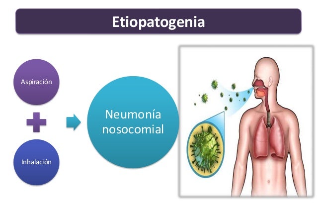 Neumonía Intrahospitalaria y asociada a ventilacion mecánica