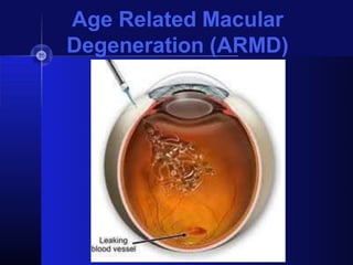 ARMD with basic retinal anatomy and management of armd | PPT