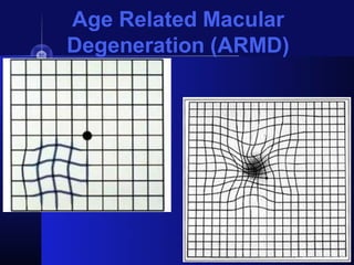 ARMD with basic retinal anatomy and management of armd | PPT