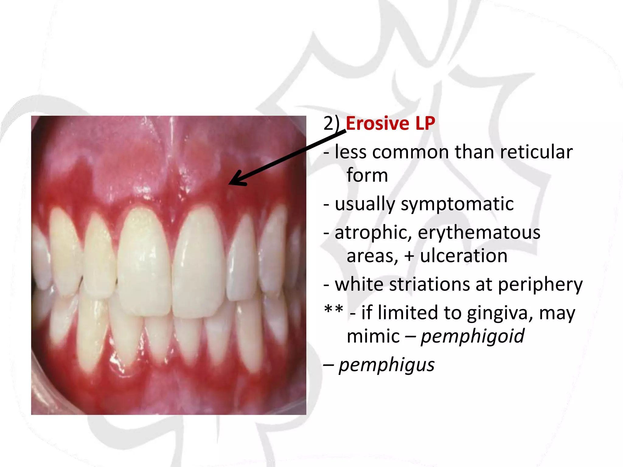 navya Desquamative Gingivitis.pptx