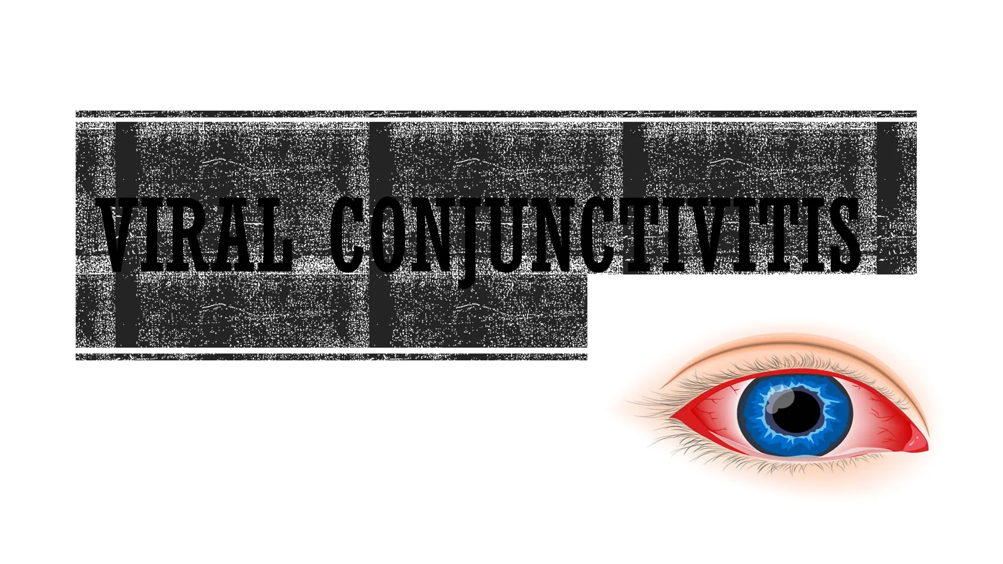 Viral conjunctivitis and its explanation | PPTX