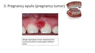 dental problem during pregnancy ........pptx