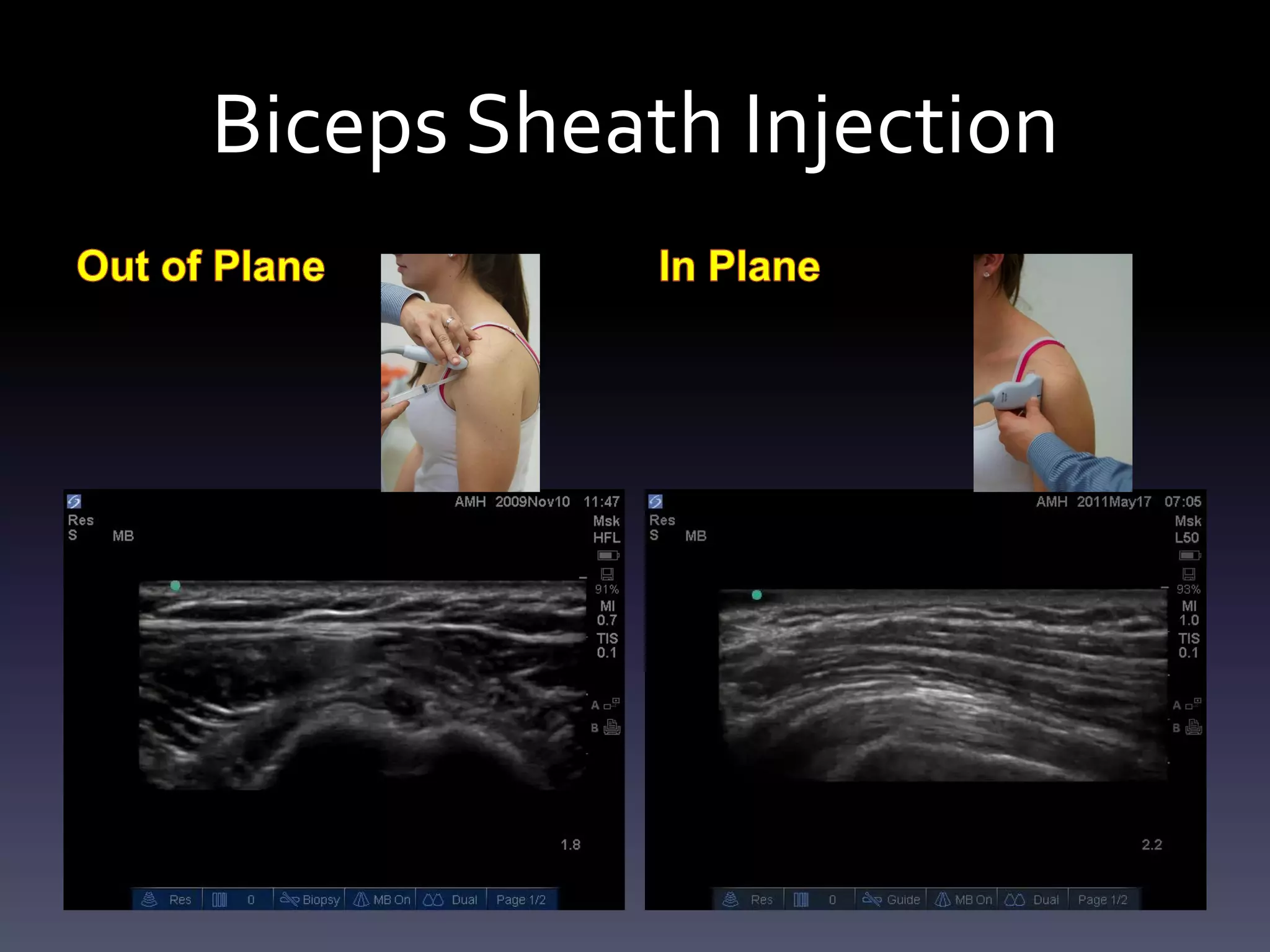 Ultrasound Guided Injections - Upper Extremity | PDF