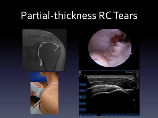 Ultrasound Guided Injections - Upper Extremity | PDF