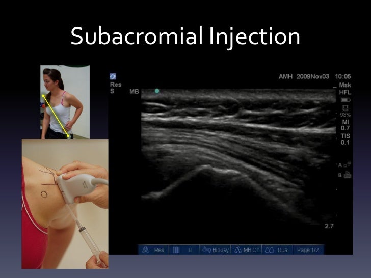 Ultrasound Guided Injections - Upper Extremity
