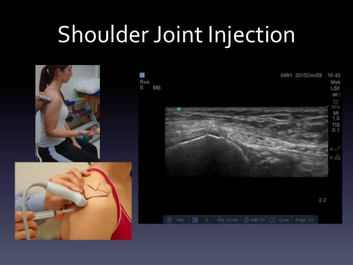 Ultrasound Guided Injections - Upper Extremity