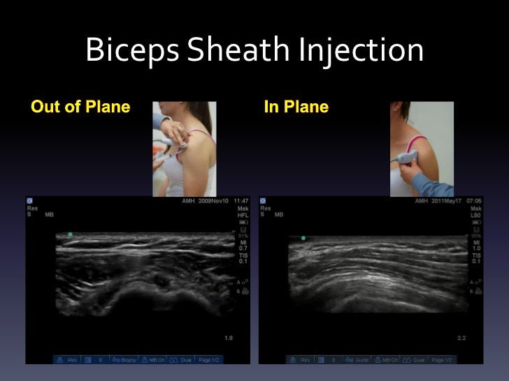 Ultrasound Guided Injections - Upper Extremity