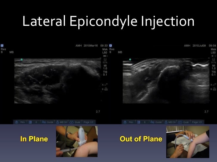 Lateral Epicondyle Injection Medial Epicondyle Injection: Background,