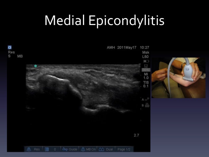 Ultrasound Guided Injections - Upper Extremity