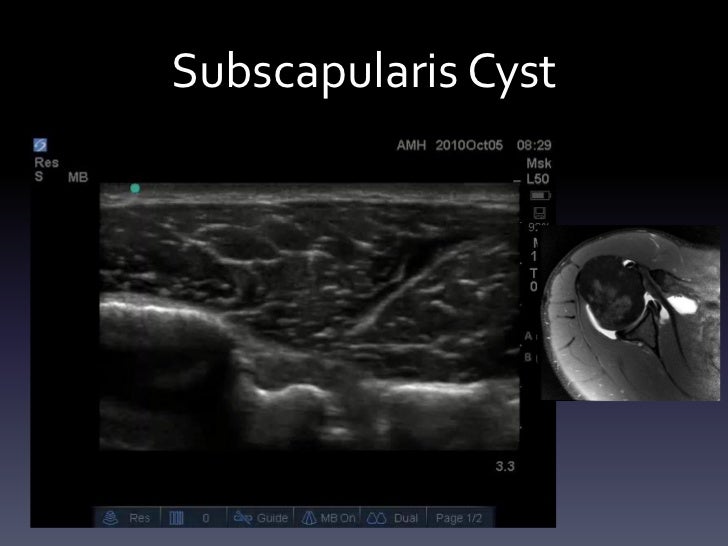 Ultrasound - Shoulder