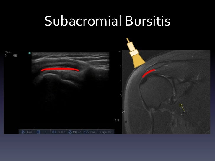 Ultrasound - Shoulder