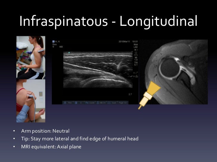 Ultrasound - Shoulder