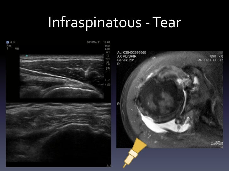 Ultrasound - Shoulder