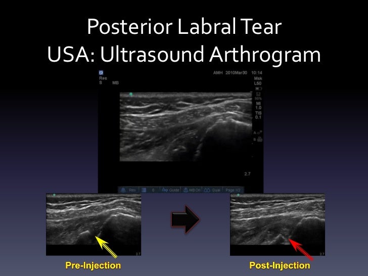 Ultrasound - Shoulder