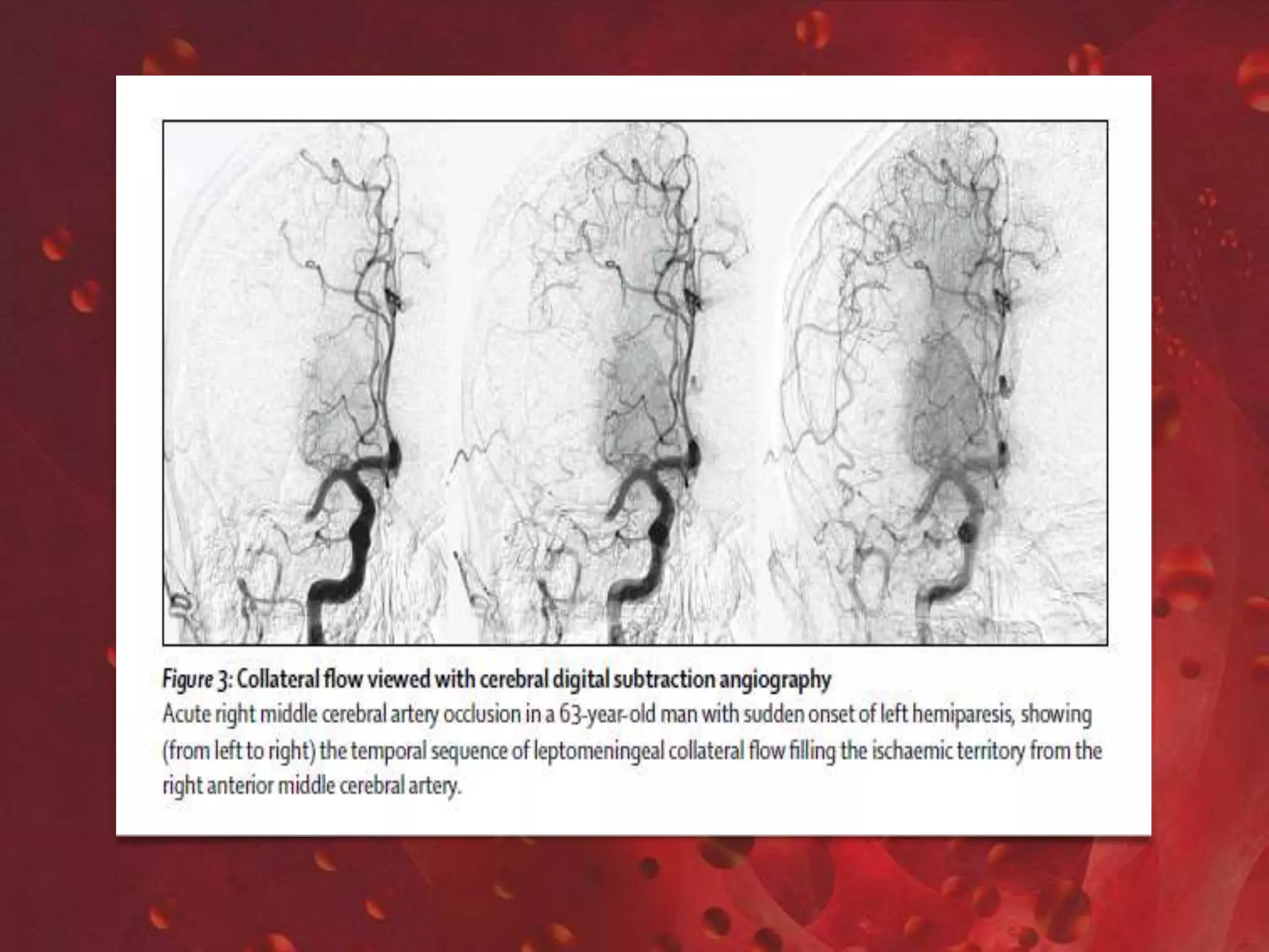 Collateral Blood Flow Dynamics in Stroke | PPT