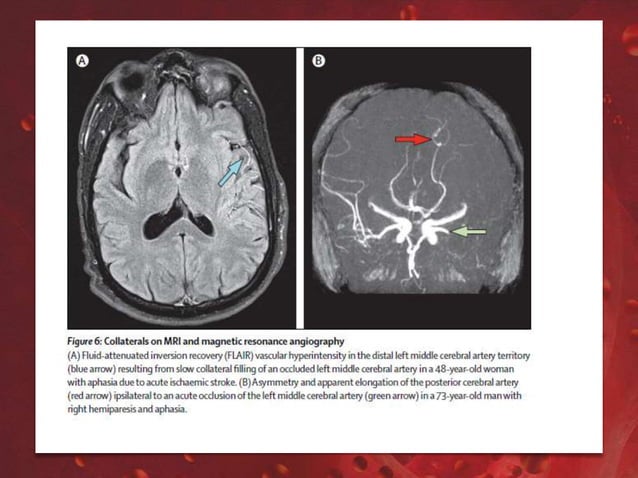 Collateral Blood Flow Dynamics in Stroke | PPT