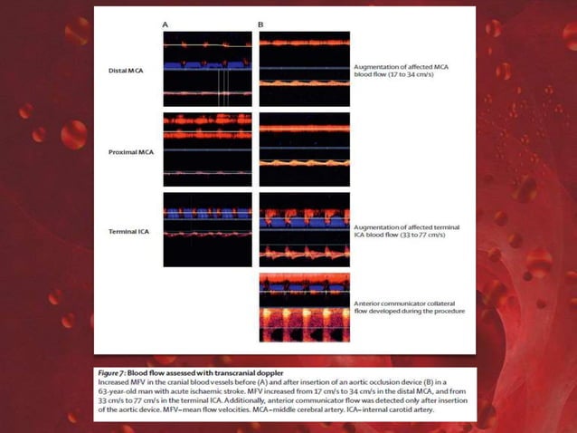 Collateral Blood Flow Dynamics in Stroke | PPT