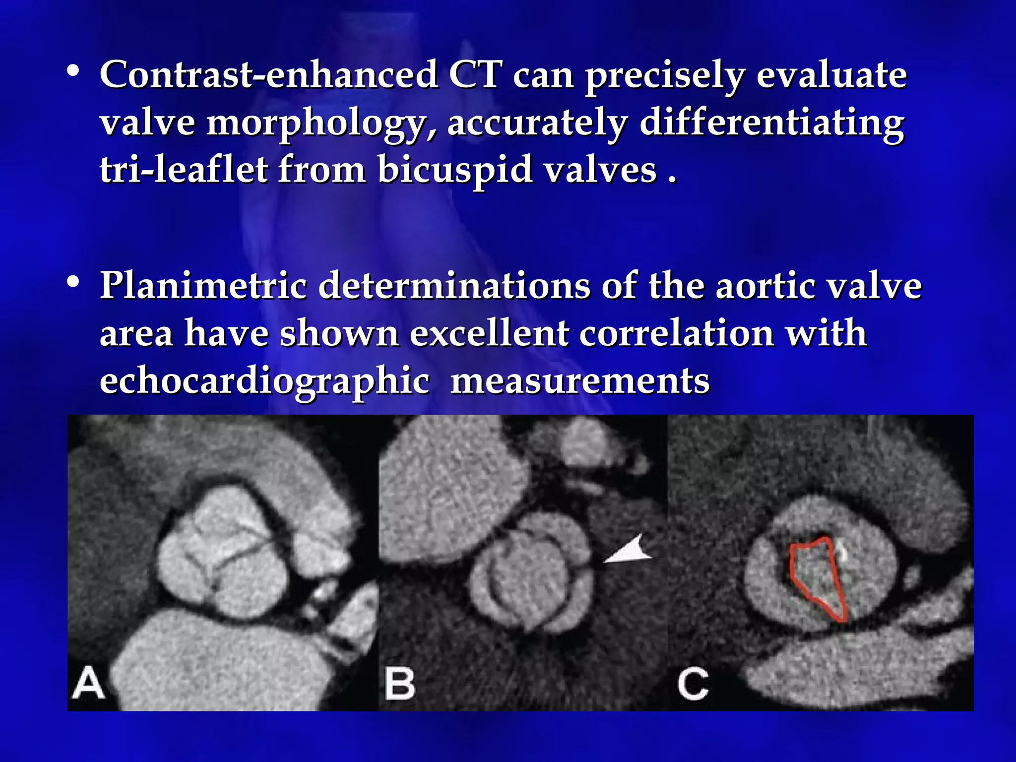Non coronary cardiac CT | PPT