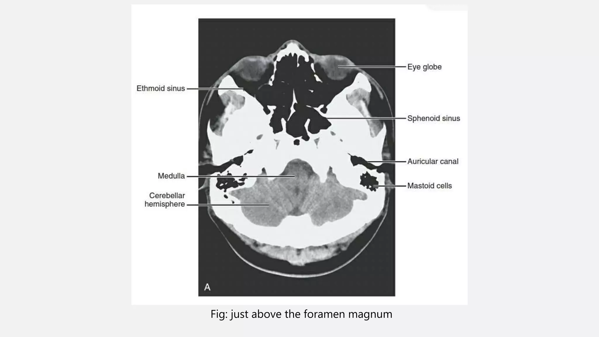 Ncct and cect brain and orbit | PPTX | Blood Disorders | Diseases and ...