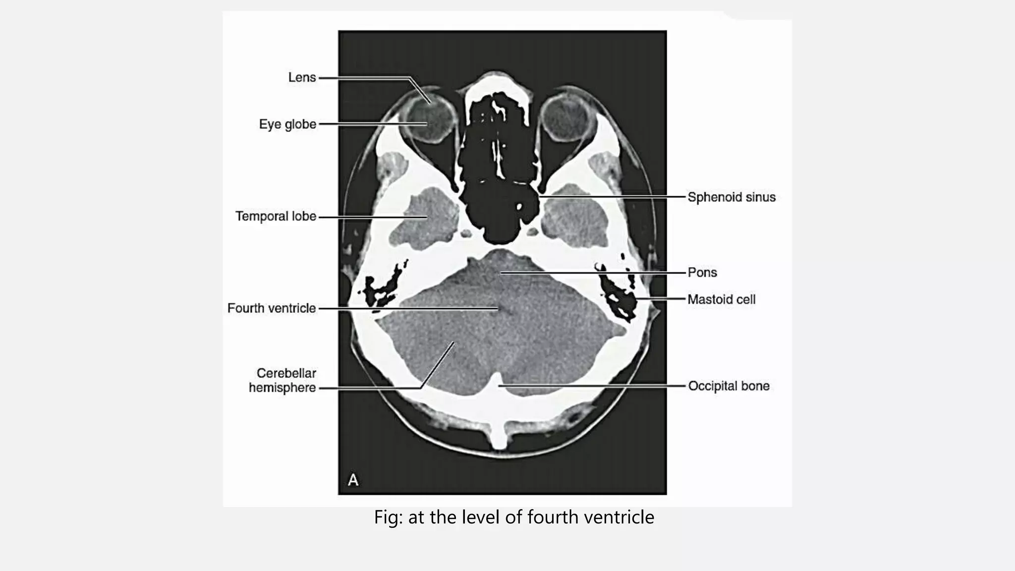 Ncct and cect brain and orbit | PPTX | Blood Disorders | Diseases and ...