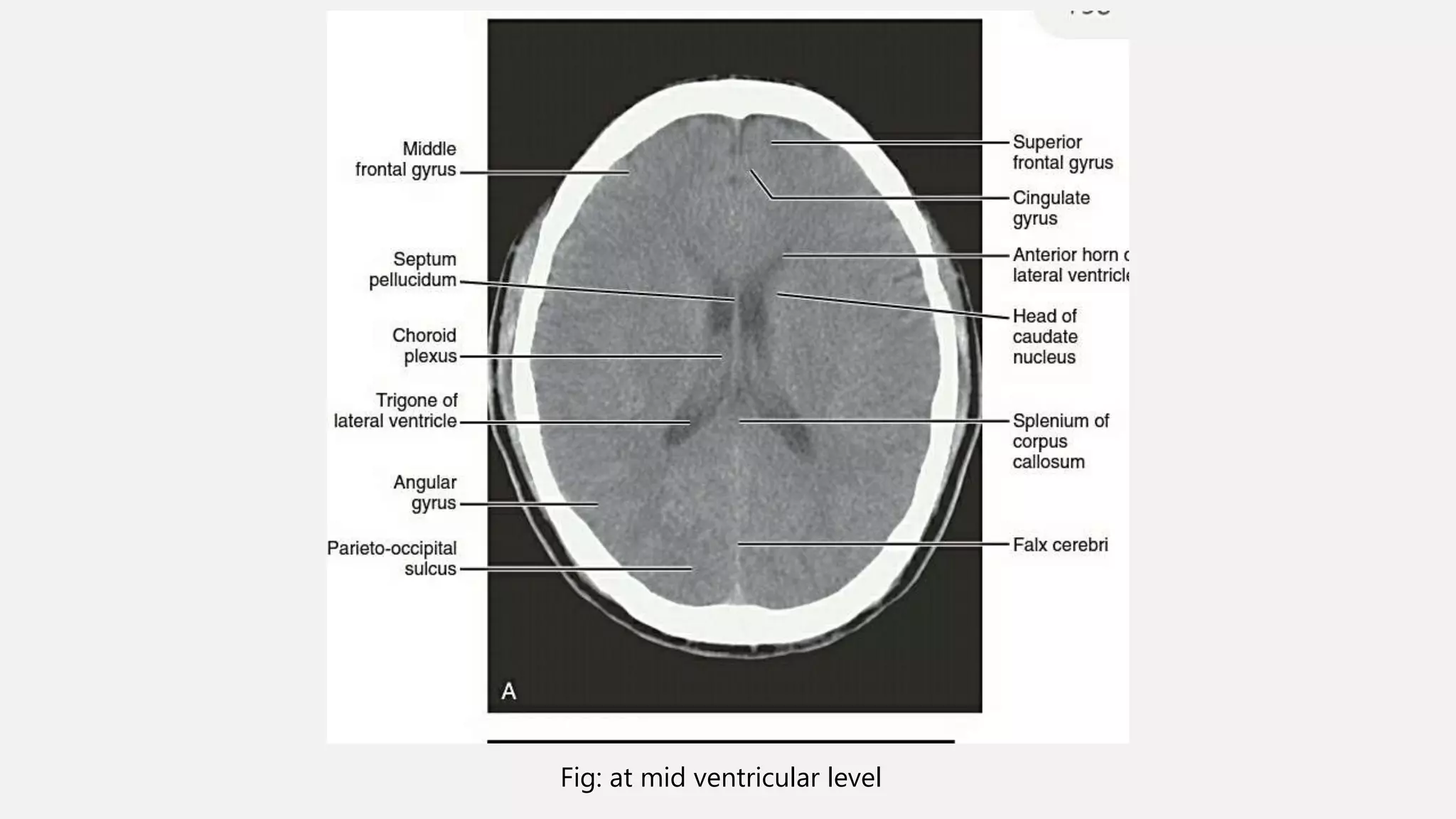 Ncct and cect brain and orbit | PPTX | Blood Disorders | Diseases and ...