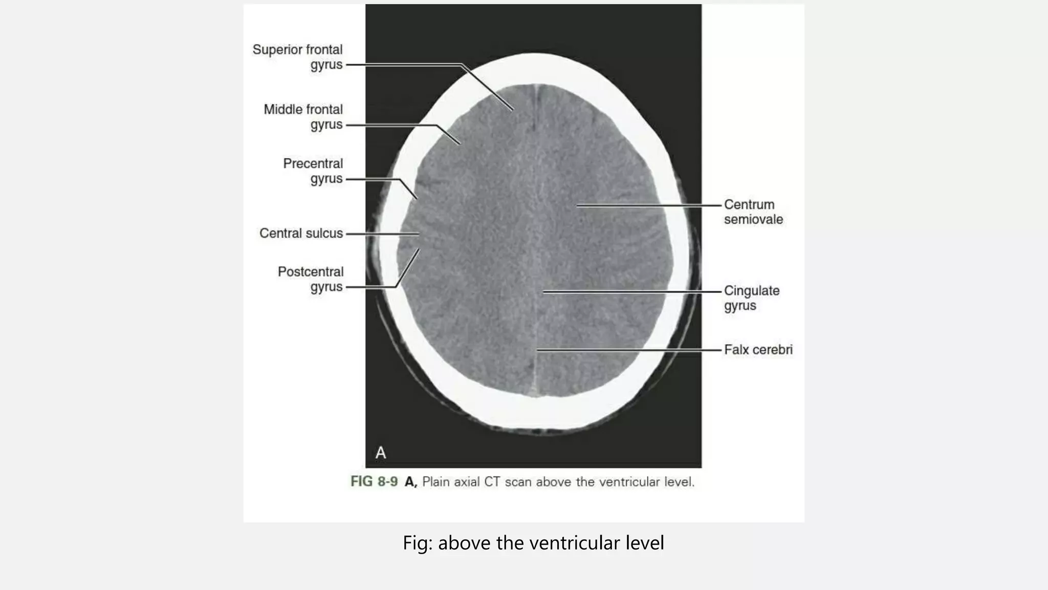 Ncct and cect brain and orbit | PPTX | Blood Disorders | Diseases and Conditions