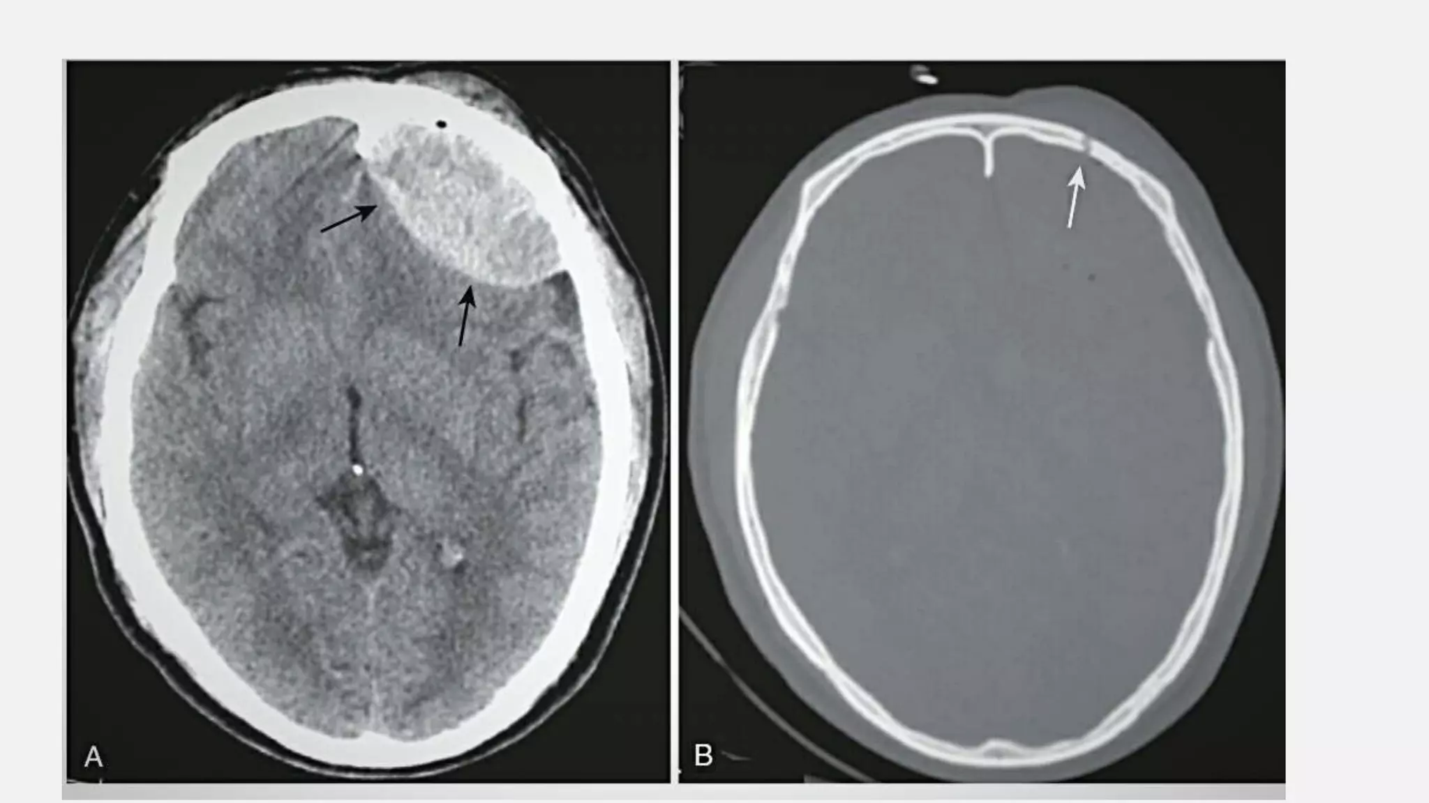 Ncct and cect brain and orbit | PPTX