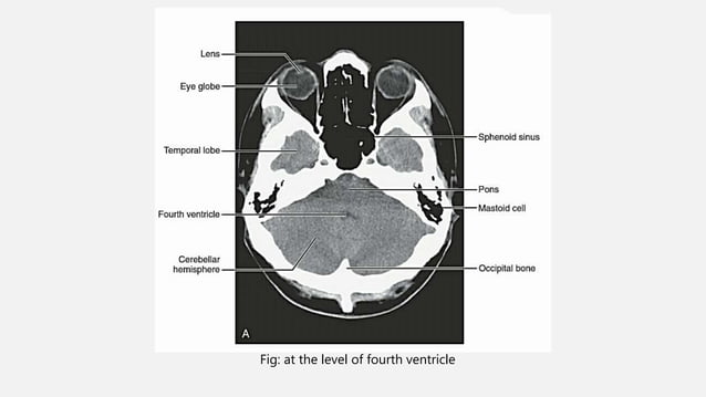 Ncct and cect brain and orbit | PPTX | Blood Disorders | Diseases and ...