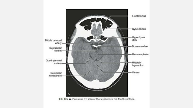Ncct and cect brain and orbit | PPTX | Blood Disorders | Diseases and ...
