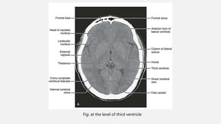 Ncct and cect brain and orbit | PPTX