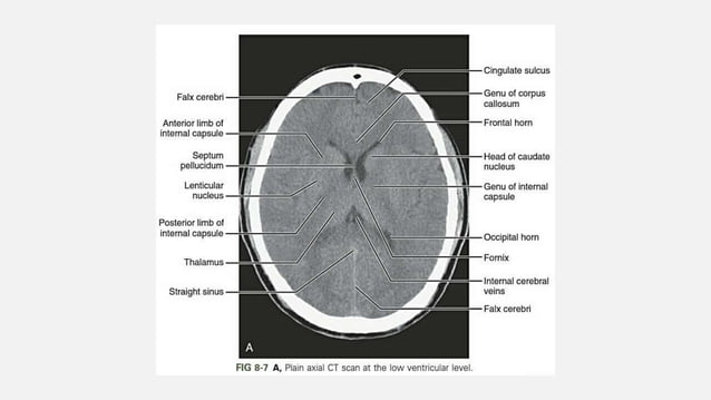 Ncct and cect brain and orbit | PPTX | Blood Disorders | Diseases and ...
